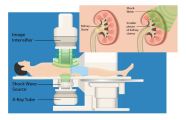 Eswl Stent Eswl Stent