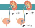 Ureteral Stents – Kidney Stone Center of Maine